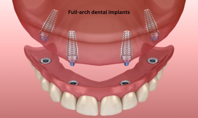 Who Should Opt For A Full-Arch Dental Implant? - Long Falls Dentistry