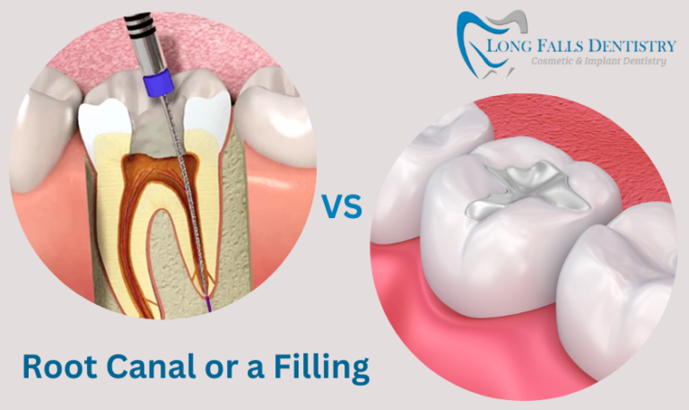 How Do I Know If I Need a Root Canal or a Filling